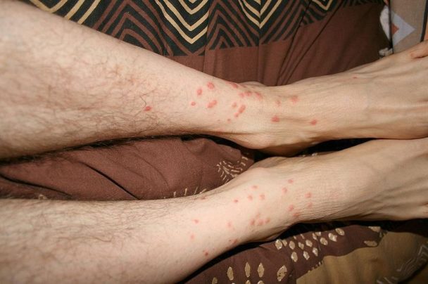 5 solutions naturelles efficaces pour soigner une piqûre d’aoûtat