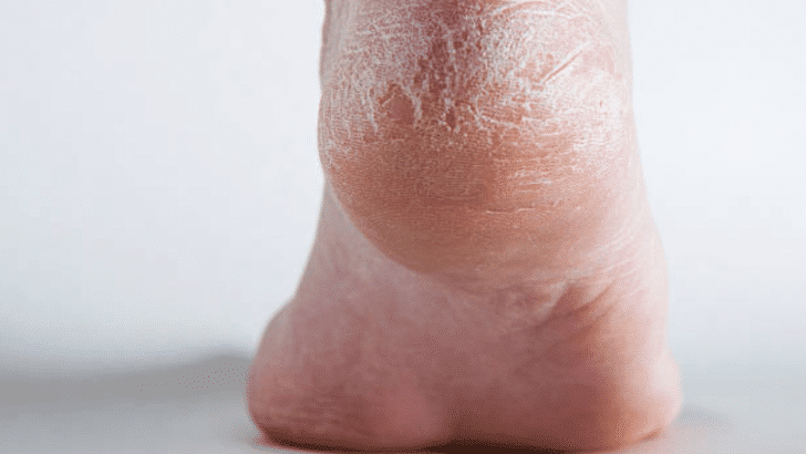 Crevasses : voici le remède naturel parfait pour les combattre