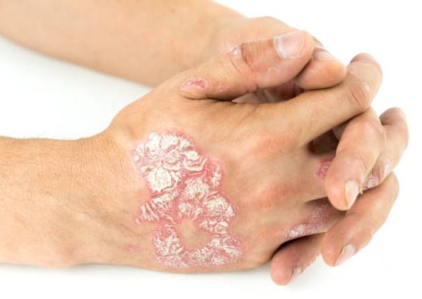 5 remèdes naturels contre le psoriasis - Astuces de Grand-Mère