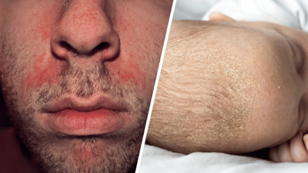 Dermite séborrhéique : 5 huiles essentielles redoutables pour la combattre